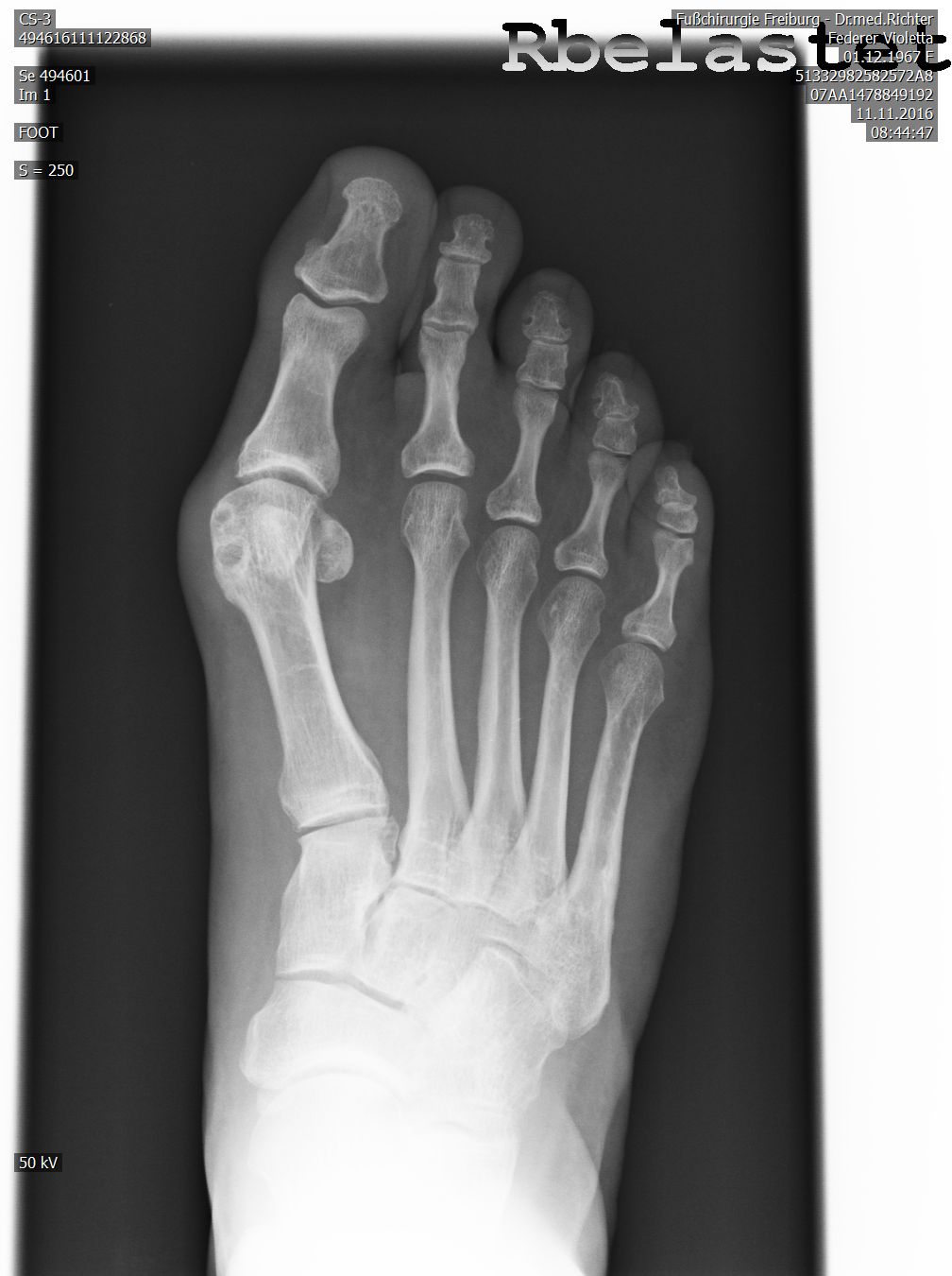 Stefan Heinzel | Fußchirurgie in Freiburg - Hallux valgus